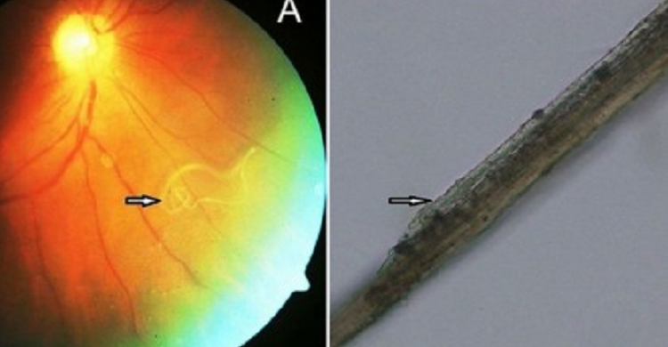 Baffled doctors find a worm living and growing in a man's eye ...