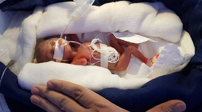 Incredible! 400-gram baby survives! (photos) - ProtoThema English