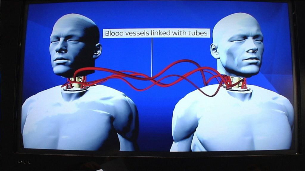 The world’s first human head transplant has been successfully carried ...