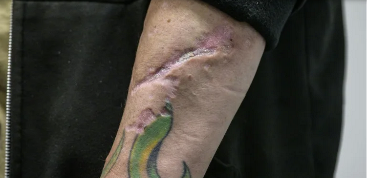 "Tranq": The flesh-rotting drug adding to America's opioid crisis ...
