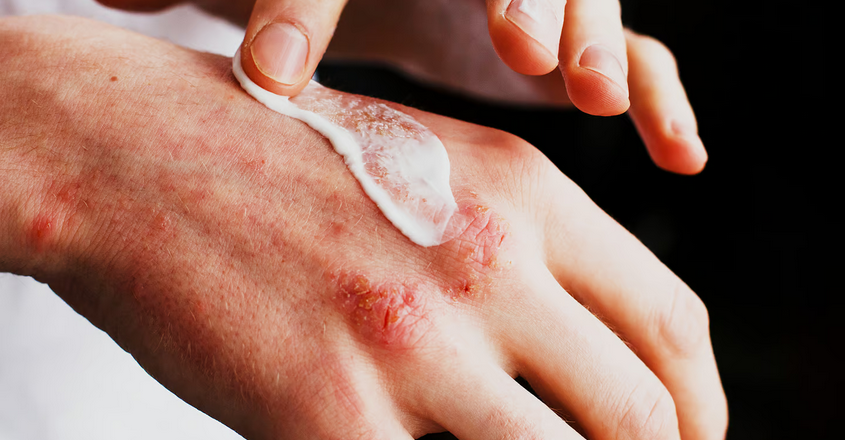 The most effective treatments for eczema according to science ...