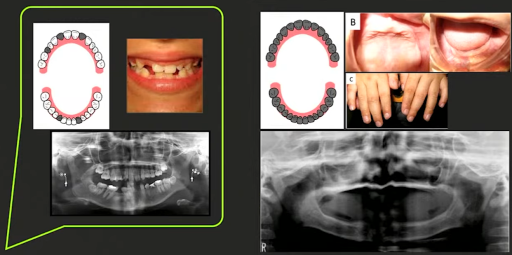 World-first tooth-regrowing drug will be given to humans in September ...